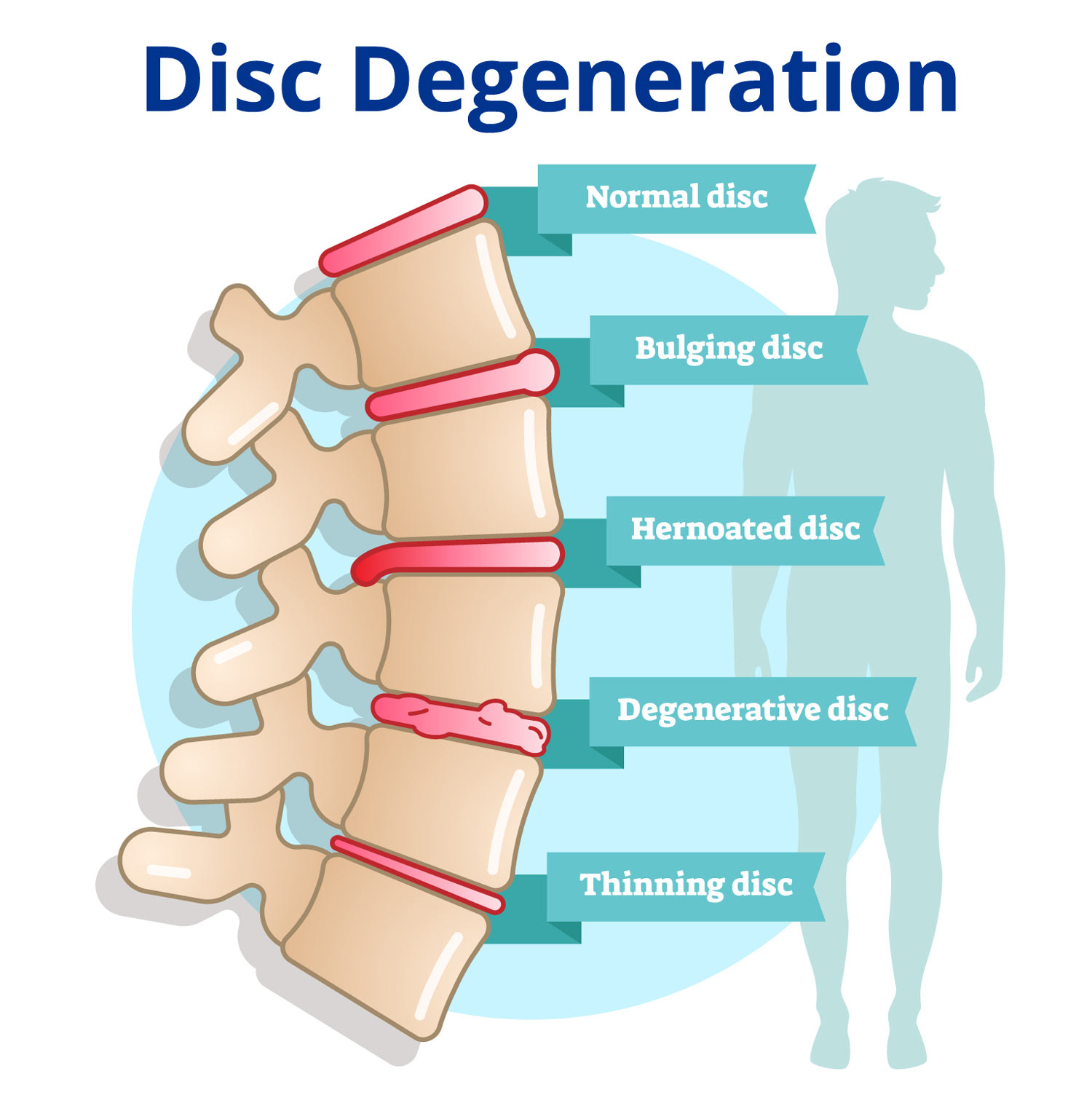 Disc Degeneration - Susquehanna Spine & Rehab
