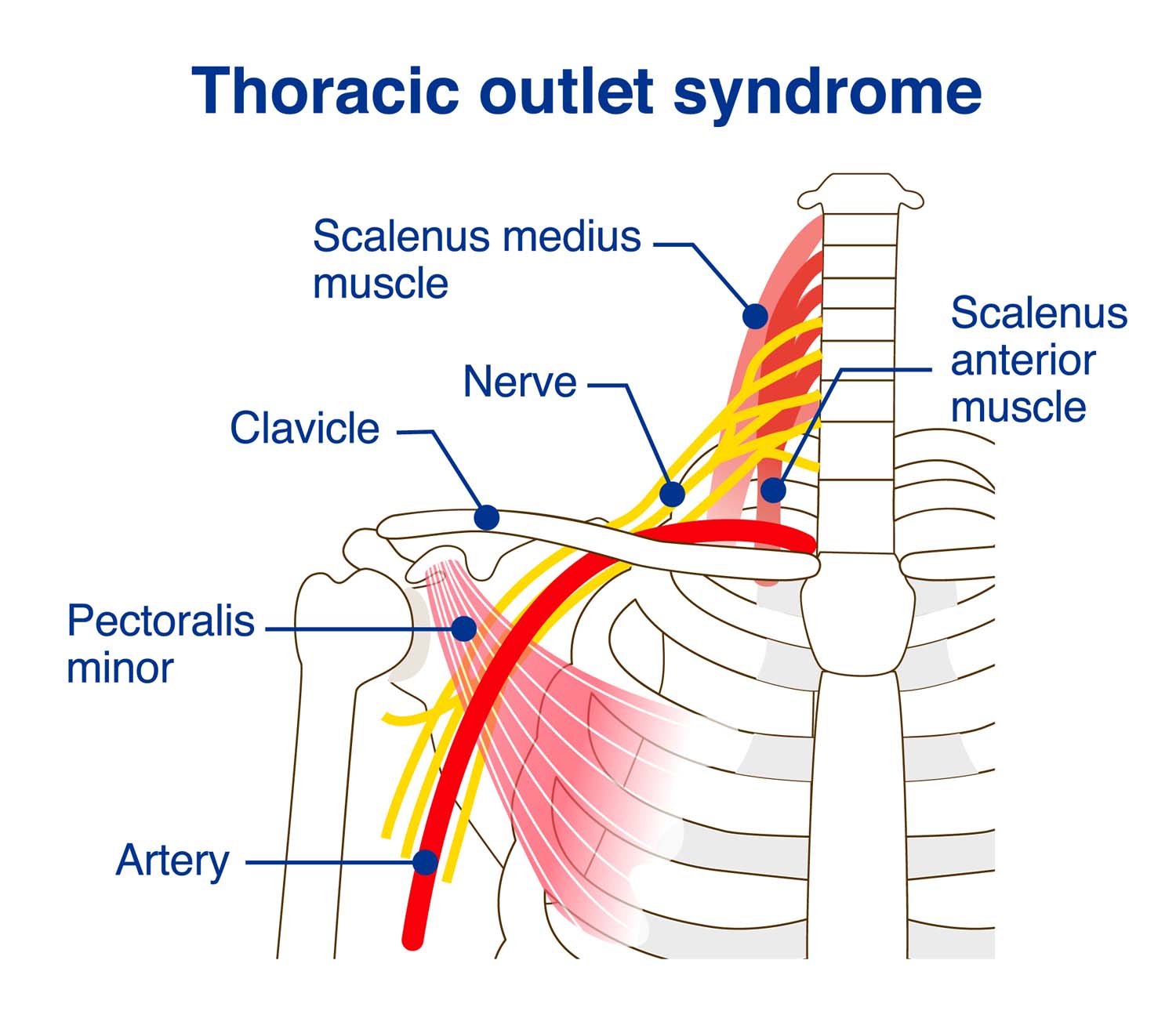 Thoracic Outlet Pain - Susquehanna Spine & Rehab
