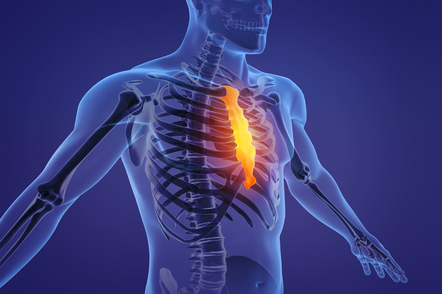 Costochondritis Costochondritis AdaptiveRX
