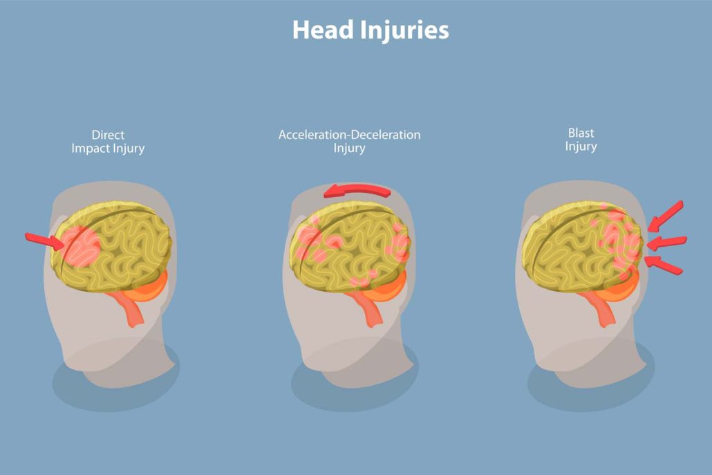 Traumatic Brain Injury (TBI) Headache Treatment - Susquehanna Spine & Rehab