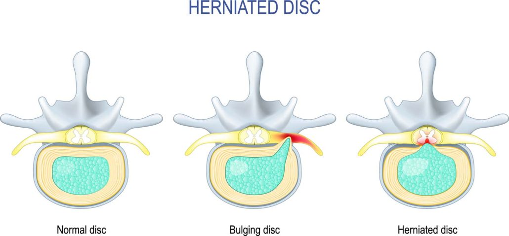 Slipped Disc, Herniated Disc, Bulging Disc Pain Treatment - Susquehanna ...
