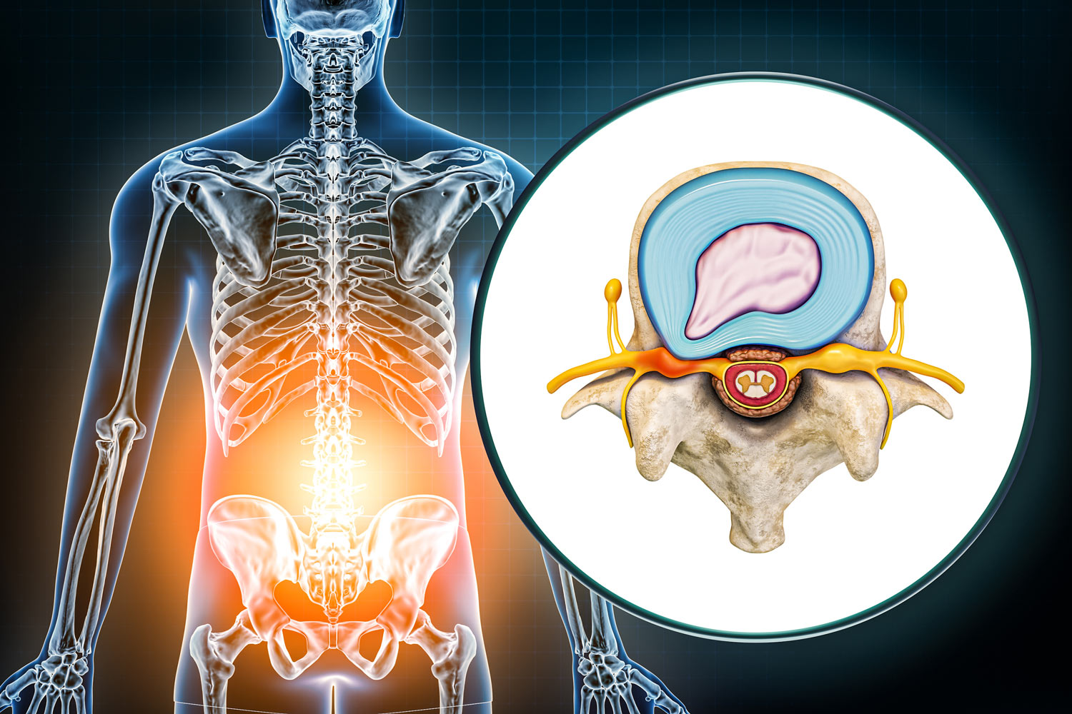 Pinched Nerve Pain Treatment - Susquehanna Spine & Rehab
